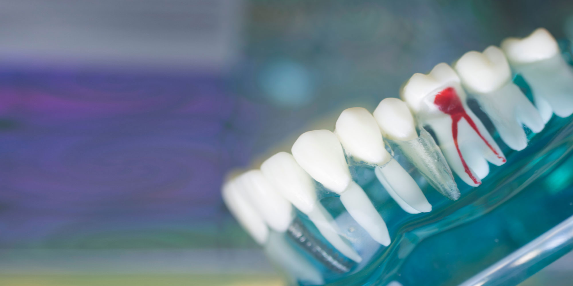 Root Canals in Albertville and Spring Lake Park, MN